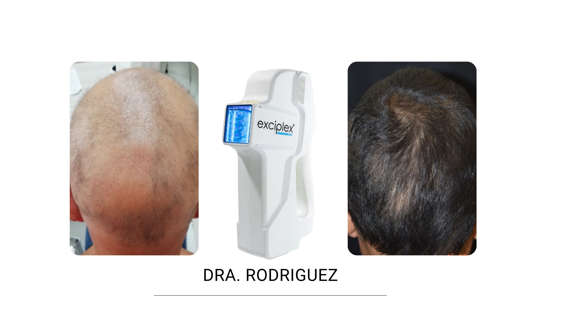 Exciplex®-Excimer Laser - Skinology 美容精華專家