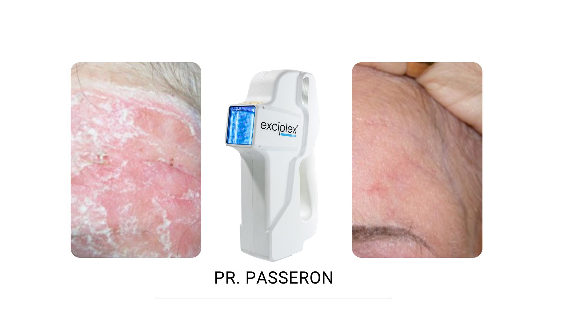 Exciplex®-Excimer Laser - Skinology 美容精華專家