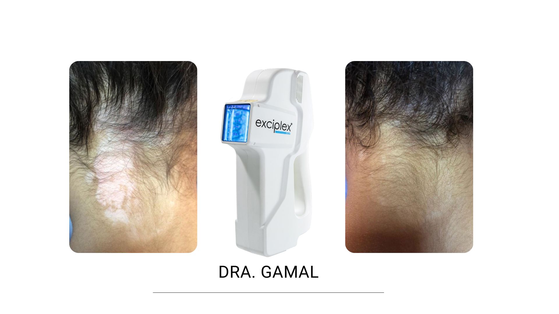 Exciplex®-Excimer Laser - Skinology 美容精華專家