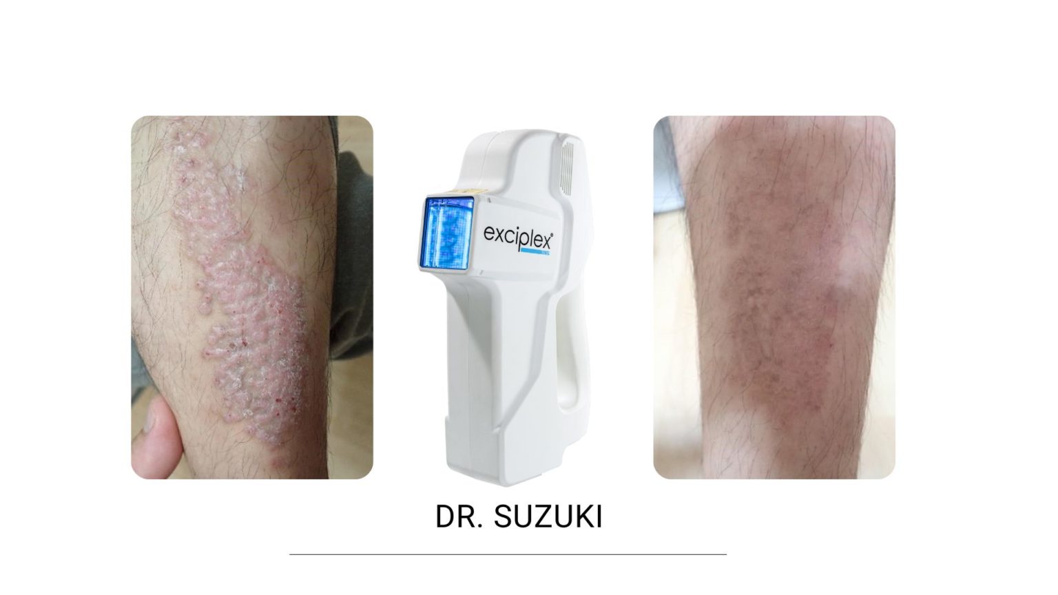 Exciplex®-Excimer Laser - Skinology 美容精華專家