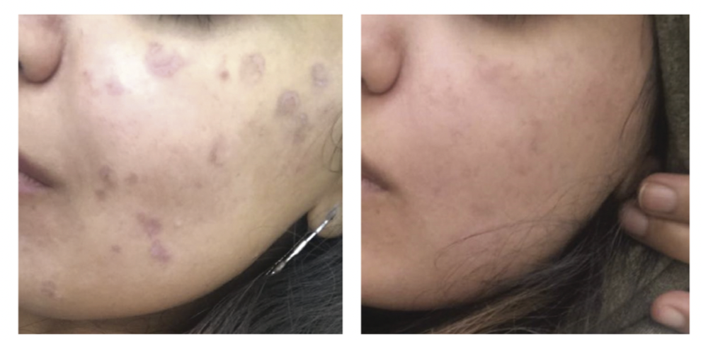 Multifrax Laser - Skinology 美容精華專家