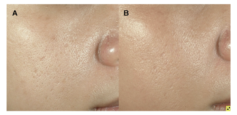 Multifrax Laser - Skinology 美容精華專家