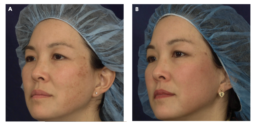 Multifrax Laser - Skinology 美容精華專家