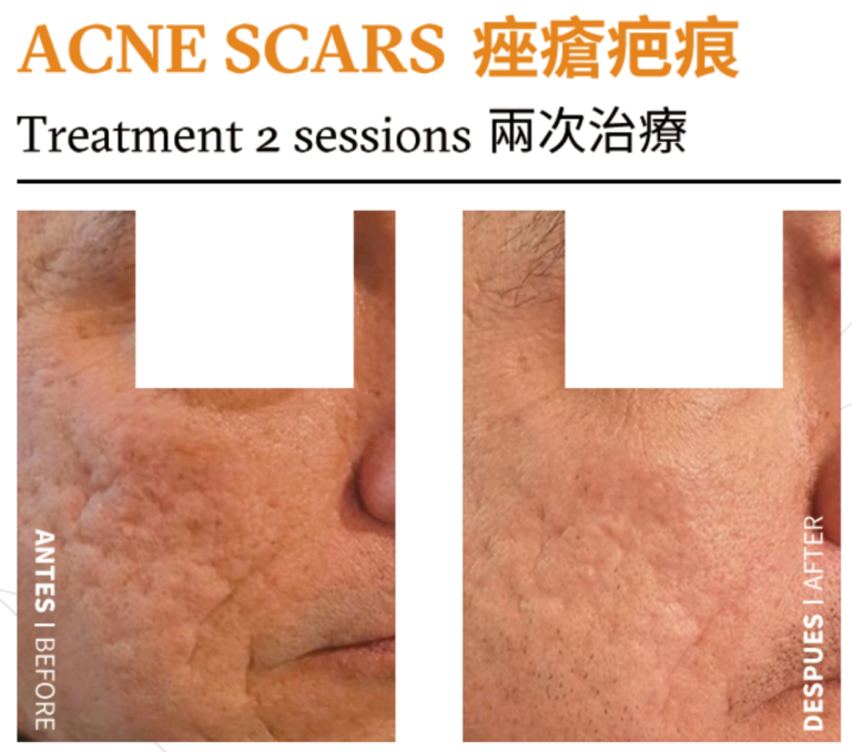 Inbiotec Amber 琥珀針 - Skinology 美容精華專家