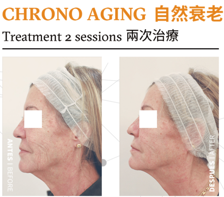 Inbiotec Amber 琥珀針 - Skinology 美容精華專家